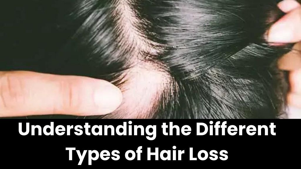 Understanding the Different Types of Hair Loss – BIOGUARDIOME